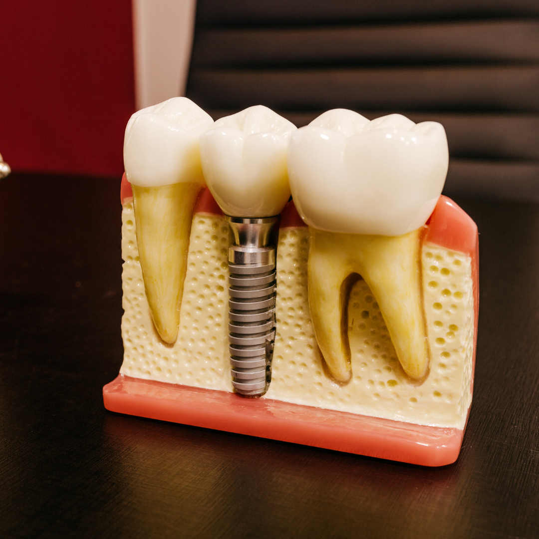 Dental Implant Surgery Recovery | What to Expect